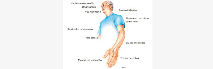 Doença de Parkinson e os Benefícios do Pilates nos Portadores