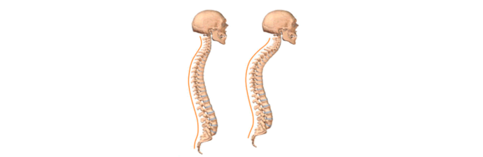 Pilates na Hipercifose Torácica: como realizar o tratamento - Blog Pilates