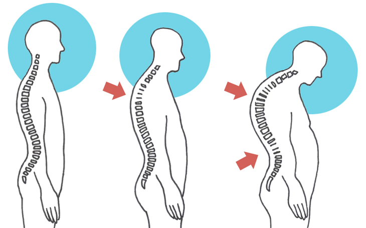 Pilates no Tratamento da Hipercifose Torácica - Blog Pilates Pilates no Tratamento da Hipercifose Torácica - Blog Pilates
